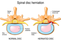How a Slipped Disc Affects Your Entire Body - Virginia Spine Specialists