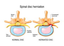 Herniated Disc: What It Feels Like and When It’s Serious - Virginia ...
